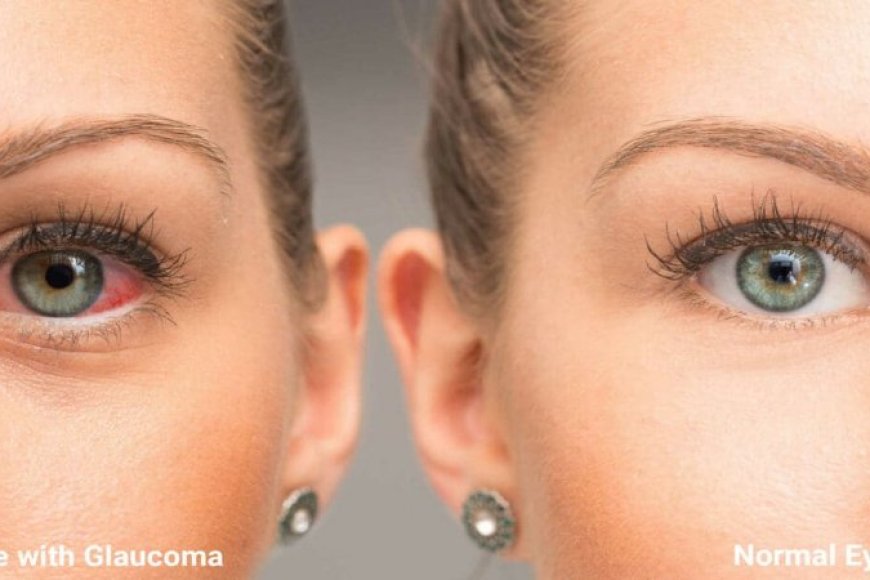 Foods That Support Eye Health and May Help Manage Glaucoma - Lovee Quotes